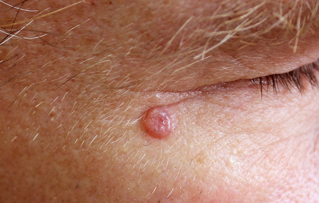 Bazalióm – najčastejší kožný nádor. Čo zvyšuje riziko vzniku ...