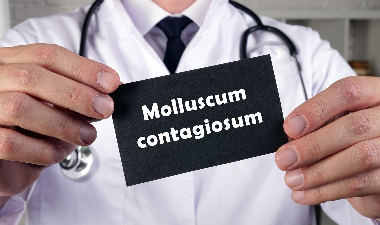 Molusky – nepríjemný spoločník malých detí. Ako ich spoznať a liečiť ...